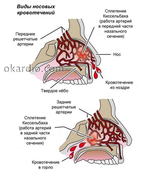 Кровь из носа: причины у взрослого и методы лечения дома