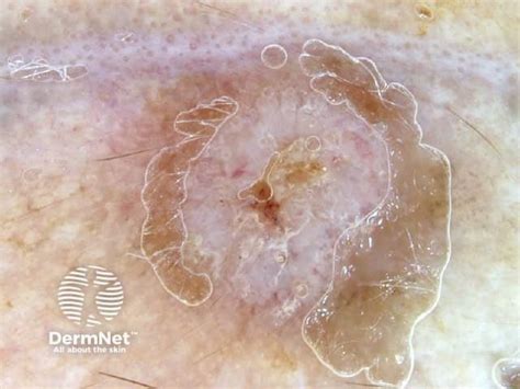 Dermoscopy Squamous Cell Carcinoma