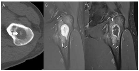 Chondrosarcoma Mri