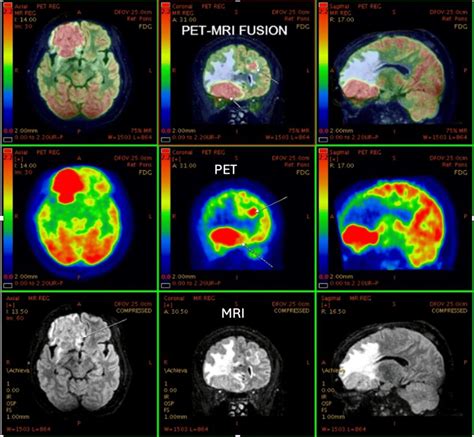 Cureus Journal Of Medical Science On Linkedin Synergy In Neuroimaging