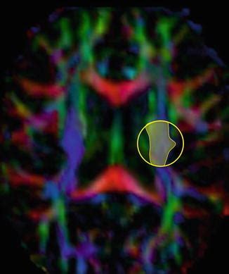 DTI Analysis Methods Voxel Based Analysis Radiology Key