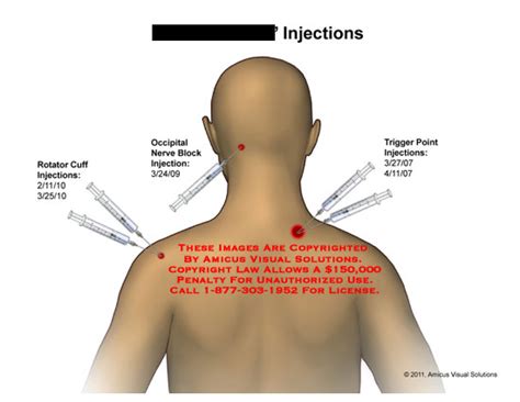 Amicus Illustration Of Amicusmedicalinjectionsrotatorcuffoccipital