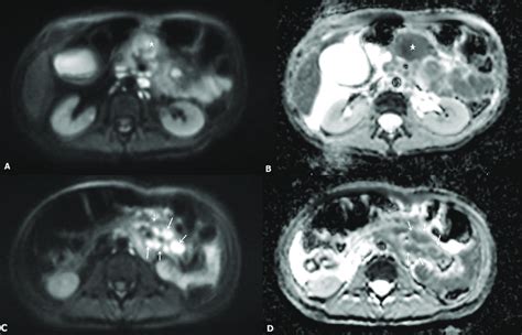 A B Axial Dwi And Corresponding Adc Images Demonstrate Heterogeneous