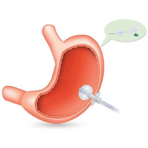 Silicone Gastrostomy Feeding Tube