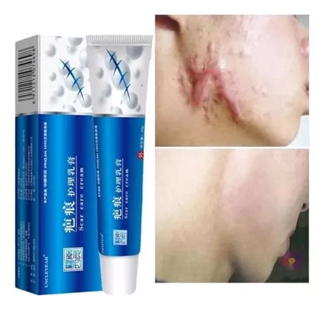 Suai Pomada Milagrosa Tira Remove Cicatrizes Queloides G Parcelamento Sem Juros