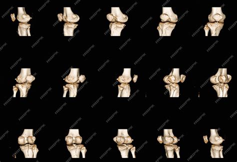 Premium Photo Collection Of Xray Humans Knee Joints Finding Fracture
