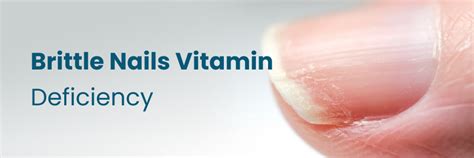 Brittle Nails Vitamin Deficiency Causes And Solutions