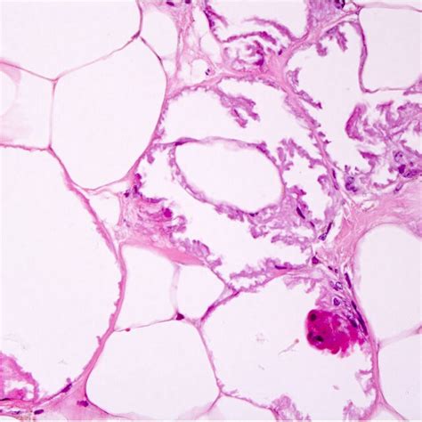 Lipomembranous Lipodystrophy Or Lipomembranous Fat Necrosis In Chronic