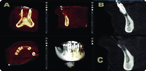 A Superimposed Pre And Post Operative CBCT Scans Same Cut Is