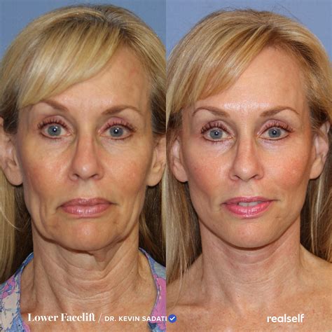Lower Facelift Vs Neck Lift Whats The Difference Lower Face Lift Surgery Neck Lift Face