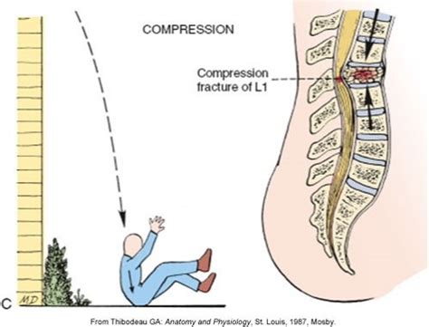 Spinal Cord Compression ME Flashcards Quizlet Spinal Cord Compression ME Flashcards Quizlet