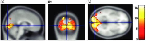 usual activation of the visual cortex in control subject no 4