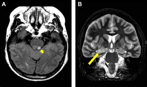 Brain Mri A Axial Flair Mri Shows Round High Signal Intensity Short