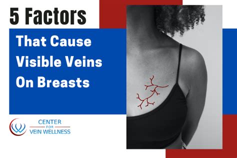 Breast Vein Treatment Ventura Vein Treatment Varicose And Spider Vein