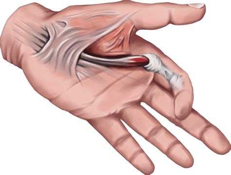 Trigger Finger Splint Rings JewelSplint