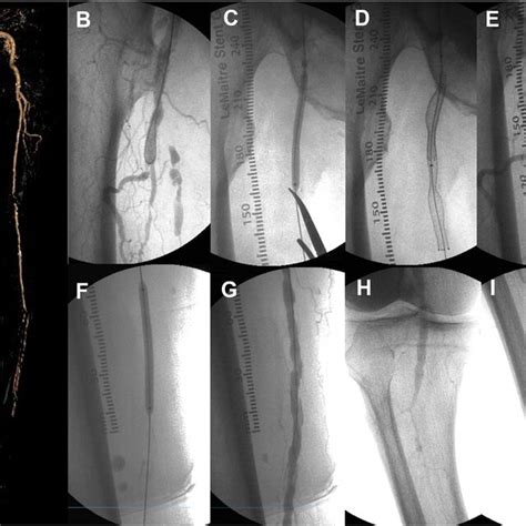 Findings Of Revascularization Preoperative Computed Tomography