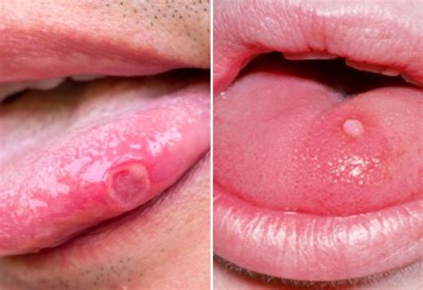 Sùi mào gà Nguyên nhân triệu chứng đường lây truyền cách điều trị