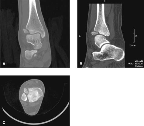 41 Operative Treatment Of Tillaux Fractures Of The Ankle