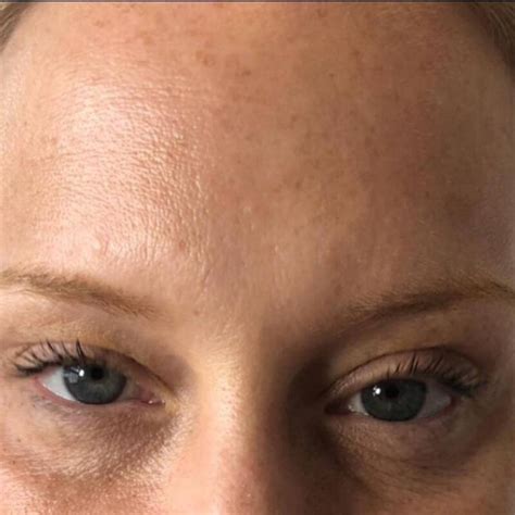 Botox Before And After Photos Rejuvenation Medical Aesthetics