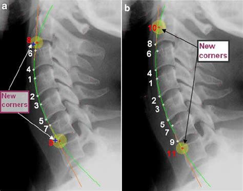 Anterior Faces Corner Extraction Progress A Extraction Of New