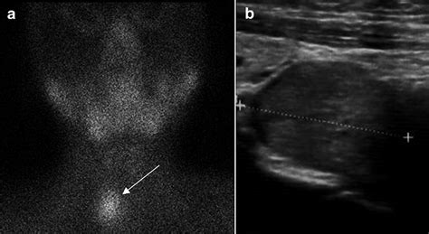 Thyroid Imaging In Case 1 99m Tc Mibi Scintigraphy A Shows A Focal