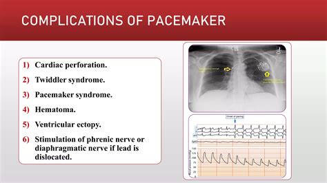 Pacemaker Pdf Heart And Cardiovascular Diseases Diseases And