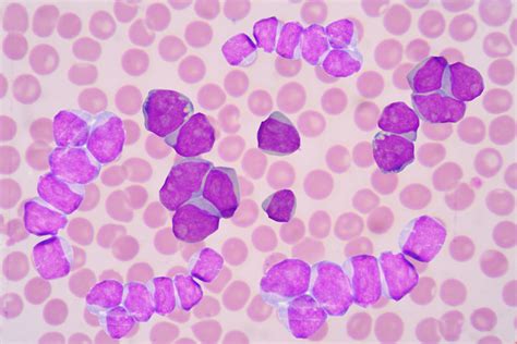 Aacr News Human Acute Myeloid Leukemia Reportedly Closely Mimicked For