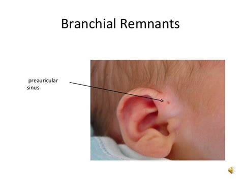 Branchial Remnants And Branchial Cyst
