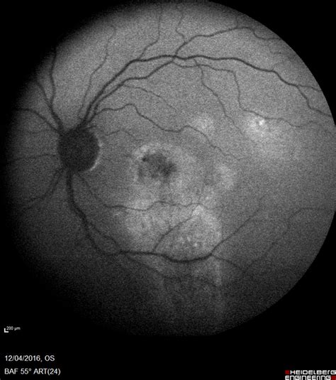 Autofluorescence Left Eye Shown Case 7 The Areas Of Download