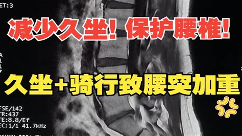 减少久坐！保护腰椎！久坐骑行导致腰突加重患者1例！ Youtube