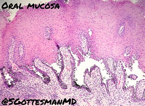 Classic Mucosal Dominant Pemphigus Silvija Gottesman Md