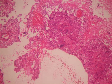 Glioblastoma Histopathologyguru