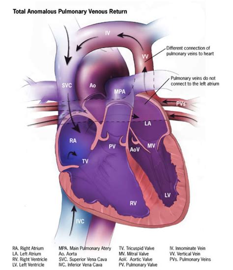 Brachiocephalic Vein Heart