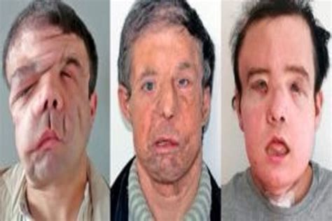 The First Person In The World To Have Two Full Face Transplants Is A