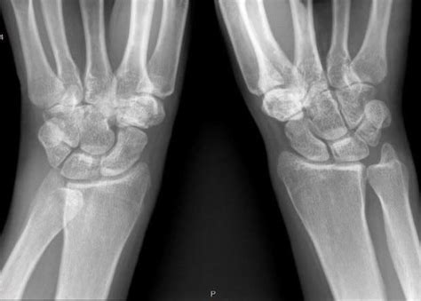 Druj Dislocated To The Max Rradiology