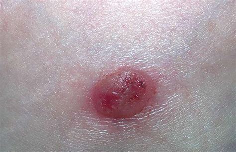 Seborrheic Keratosis Causes Symptoms Home Treatment