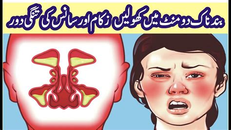 Band Naak Ka Ilaj Stuffy Nose Home Remedies Stuffy Nose Treatment