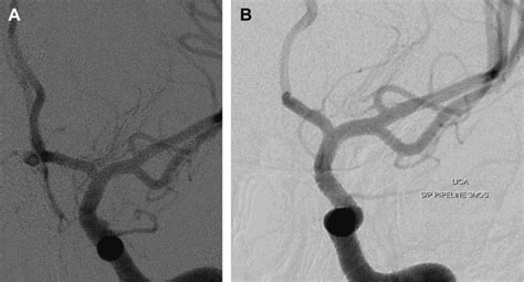 Treatment Of Blister Like Aneurysms With The Pipeline Embolization