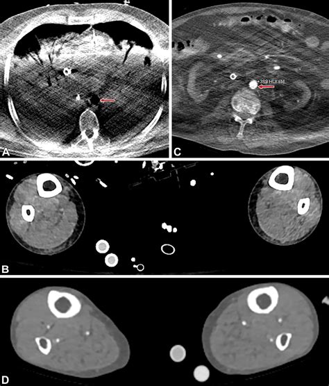 Ct Angiography Of Venoarterial Extracorporeal Membrane Oxygenation