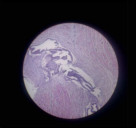 Histopathology Of Umbilical Nodule Showing Benign Endometrial Tissue