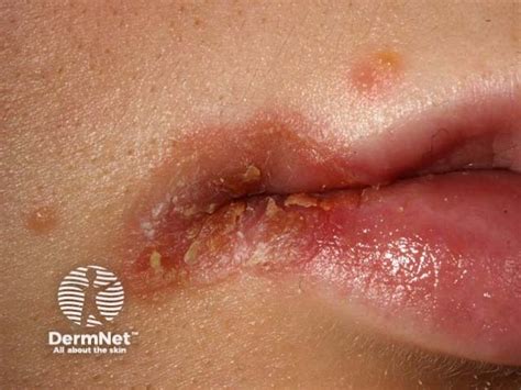 Dermnet® Angular Cheilitis Image