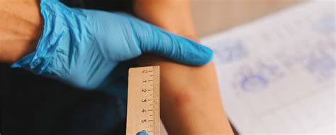 Tuberculosis Testing