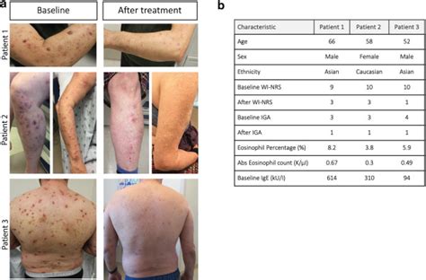 Dupilumab Therapy Modulates Circulating Inflammatory Mediators In