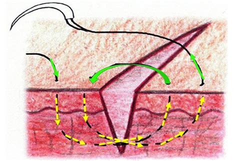 Optimal Suture Results Slideshow