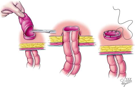 Stoma Prolapse Springerlink