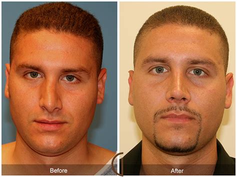 Nasal Fracture Surgery