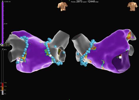 Mikael Laredo On Linkedin 100 Focal Pfa Pulmonary Vein Isolation