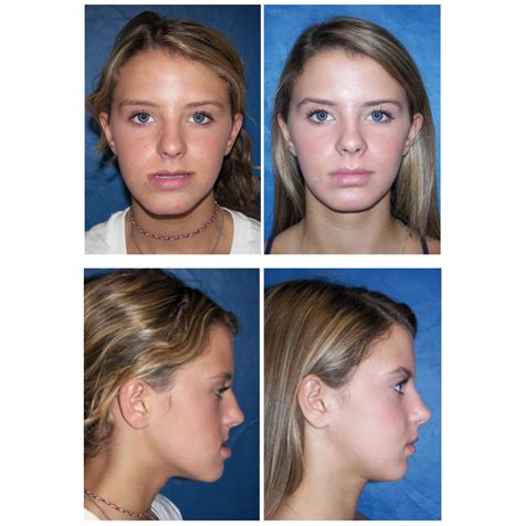 Before And After Surgery Photos Dr Larry M Wolford Dmd