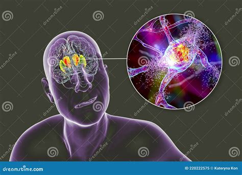 Dorsal Striatum Highlighted In The Brain Of A Person With Chorea