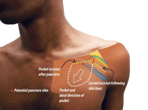 인공심장박동기pacemaker 제세동기icd 시술 과정 시술 시간